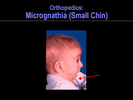 Turner Syndrome: Toward Early Recognition and Improved Outcomes