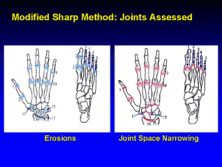 Advancing the Art and Science of Treating RA and Spondyloarthropathies ...