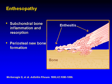 Advancing the Art and Science of Treating RA and Spondyloarthropathies ...