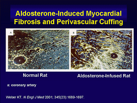The Evolving Role of Aldosterone in Cardiovascular Disease: Rationale ...