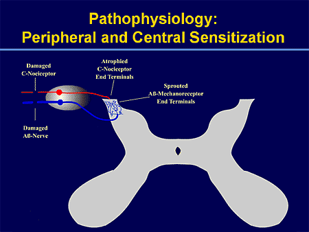 Managing Neuropathic Pain: New Approaches For Today's Clinical Practice