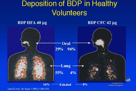 The Suspension Is Over: New Solutions for the Treatment of Asthma