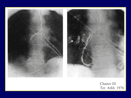 Intersection of Acute Coronary Syndromes and Heart Failure: From the ...