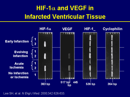 Intersection of Acute Coronary Syndromes and Heart Failure: From the ...