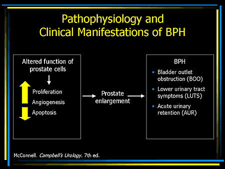 Improving Men's Health: Innovations in the Treatment of Prostate Cancer