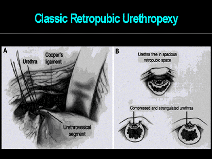Stress Urinary Incontinence: Expanding the Treatment Options
