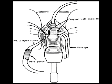 Stress Urinary Incontinence: Expanding the Treatment Options