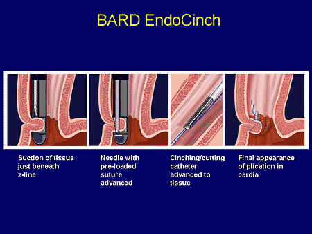 Closing the Gap in Upper GI Disorders: A Comprehensive Approach