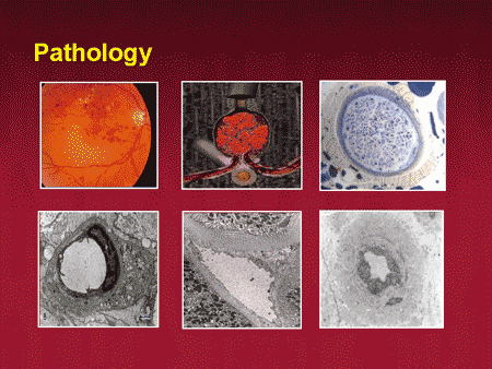 Pathways Leading to Diabetic Microvascular Complications and the Latest ...