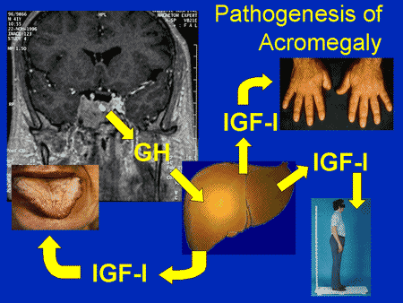 Advanced Strategies for Achieving IGF-I Control in Acromegaly