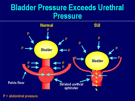 New Horizons in Stress Urinary Incontinence Treatment