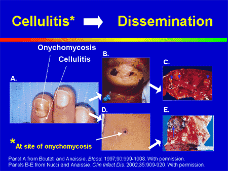Management of Mycoses: Expanding Therapeutic Options