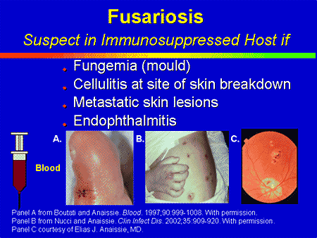 Management of Mycoses: Expanding Therapeutic Options