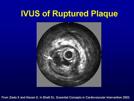 Challenges in the Long-term Management of Patients Post Stent ...