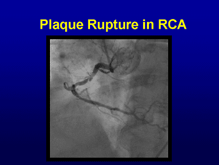 Challenges in the Long-term Management of Patients Post Stent ...