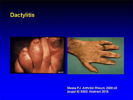 New Horizons in TNF Inhibition - Topic 1: Treating Ankylosing Spondylitis