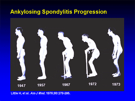 New Horizons in TNF Inhibition - Topic 1: Treating Ankylosing Spondylitis