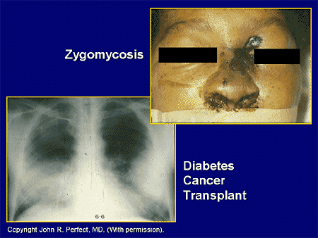 Update on Fungal Disease 2003