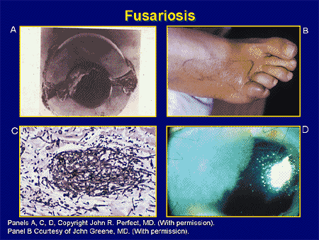 Update on Fungal Disease 2003