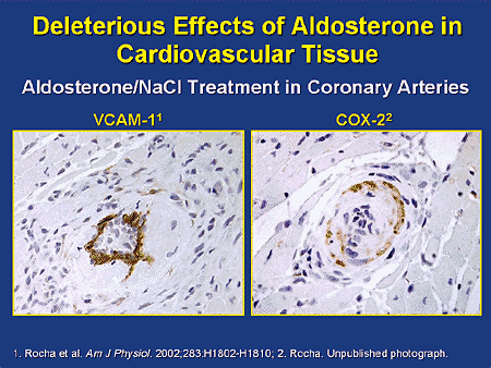 The Evolution of Heart Failure Management: The Role of Aldosterone