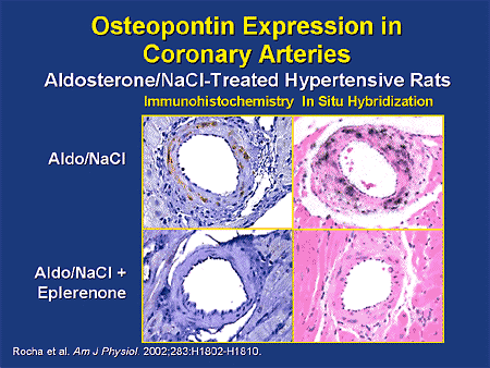 The Evolution of Heart Failure Management: The Role of Aldosterone