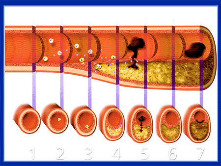 A New Dawn of the Treatment of Dyslipidemia: Cardiovascular Risk ...