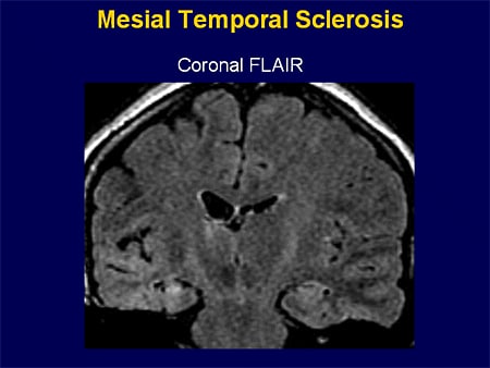Temporal Lobe Epilepsy: The Current State of Knowledge