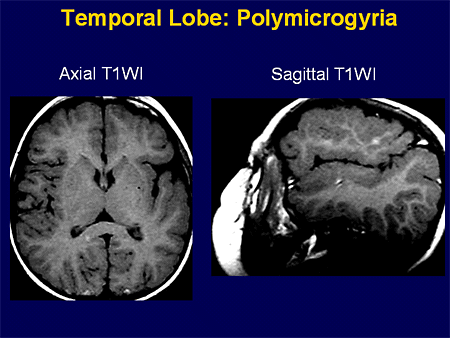 Temporal Lobe Epilepsy: The Current State of Knowledge