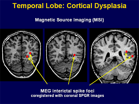Temporal Lobe Epilepsy: The Current State of Knowledge