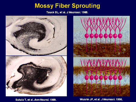 Temporal Lobe Epilepsy: The Current State of Knowledge
