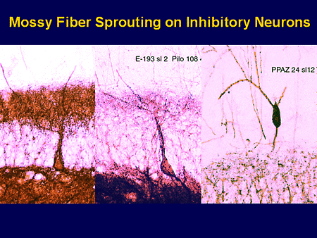 Temporal Lobe Epilepsy: The Current State of Knowledge