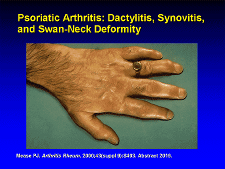 New Horizons in TNF Inhibition - Topic 2: Targeting Psoriatic Arthritis
