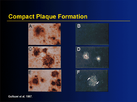 The Treatment of Alzheimer's Disease and Disease Progression Modification