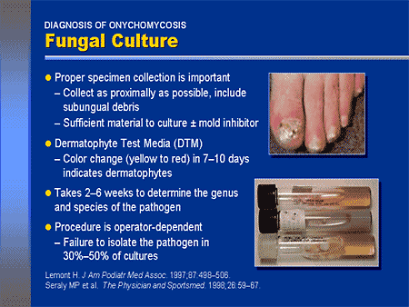 Fungal Nail Infections: Treating From Head To Toe