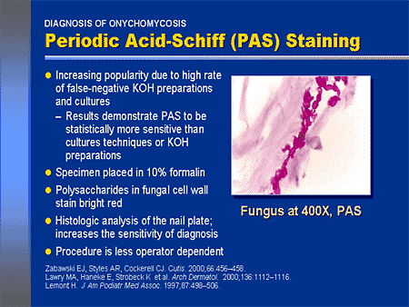 Fungal Nail Infections: Treating From Head To Toe