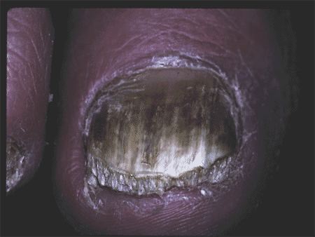 Fungal Nail Infections: Treating From Head To Toe