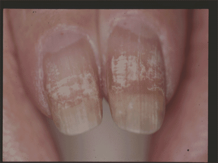 Fungal Nail Infections: Treating From Head To Toe