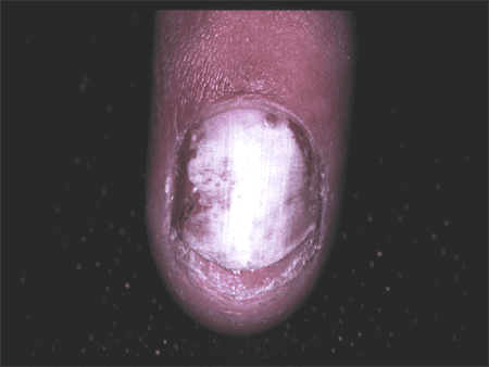 Fungal Nail Infections: Treating From Head To Toe