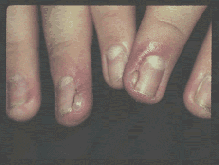 Fungal Nail Infections: Treating From Head To Toe