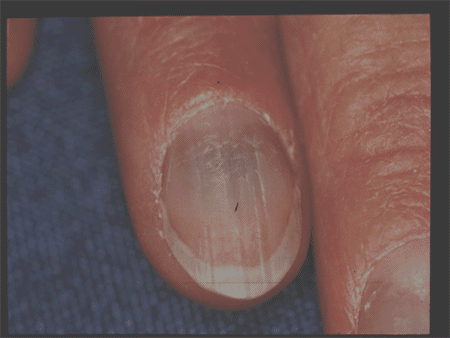 Fungal Nail Infections: Treating From Head To Toe