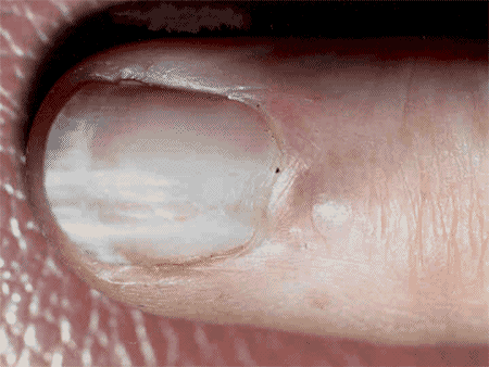 Fungal Nail Infections: Treating From Head To Toe