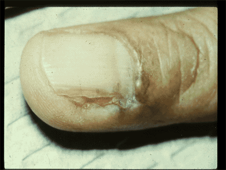 Fungal Nail Infections: Treating From Head To Toe
