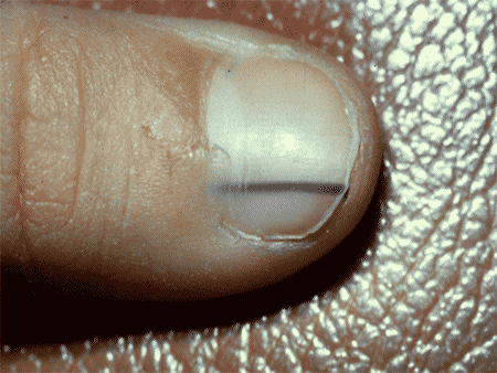 Fungal Nail Infections: Treating From Head To Toe