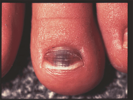Fungal Nail Infections: Treating From Head To Toe