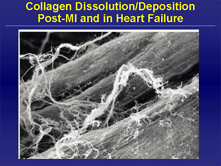Aldosterone Blockade: The New Key to More Survival in Post-Infarction ...