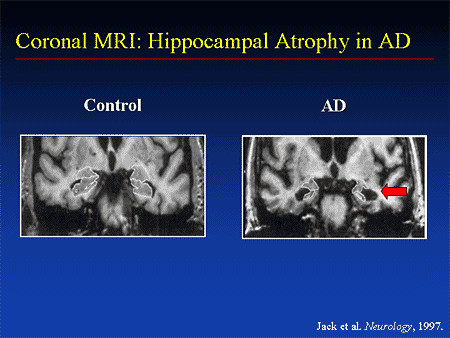 Current Alzheimer's Disease Treatments and Beyond: Advances Impacting Clinical Practice