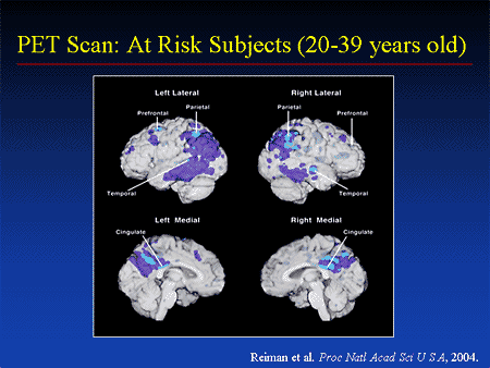 Current Alzheimer's Disease Treatments and Beyond: Advances Impacting ...