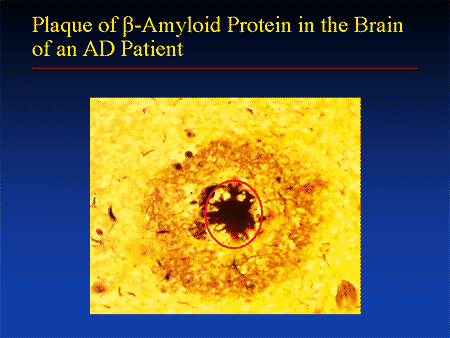 Current Alzheimer's Disease Treatments and Beyond: Advances Impacting ...