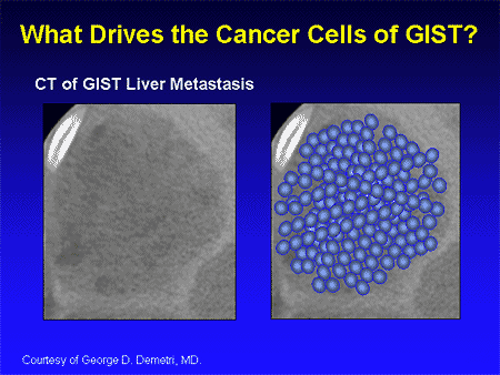 GI Cancer Challenge: Establishing Treatment Strategies Within the ...