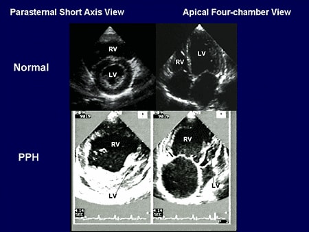 The Art and Science of the Right Heart: Diagnosis and Treatment of ...